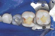 Reliable, Durable Class II Posterior Resin Composite Restorations ...