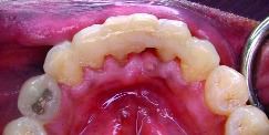 Single Visit Natural Tooth Pontic Bridge with Fiber Reinforcement ...