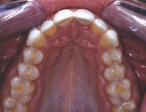 Aesthetic Rehabilitation Of Maxillary Central Incisors Using All ...