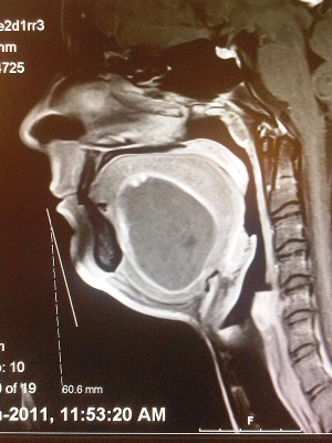 Midline Submental Dermoid Cyst: A Case Report - Oral Health Group