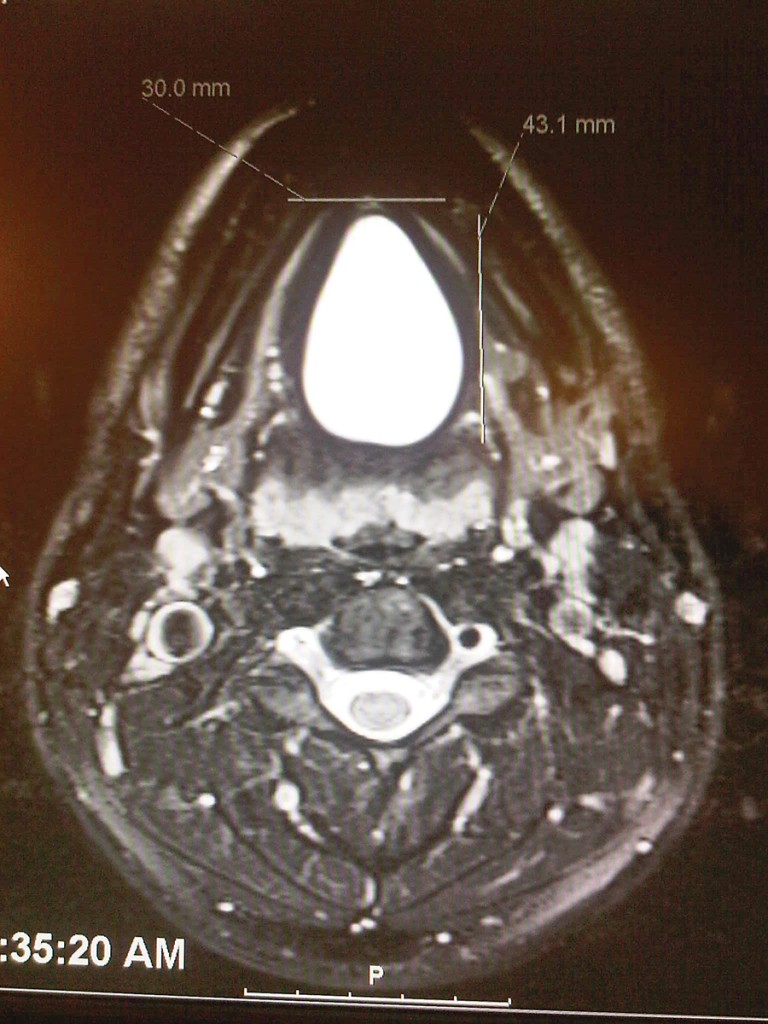 Midline Submental Dermoid Cyst: A Case Report - Oral Health Group
