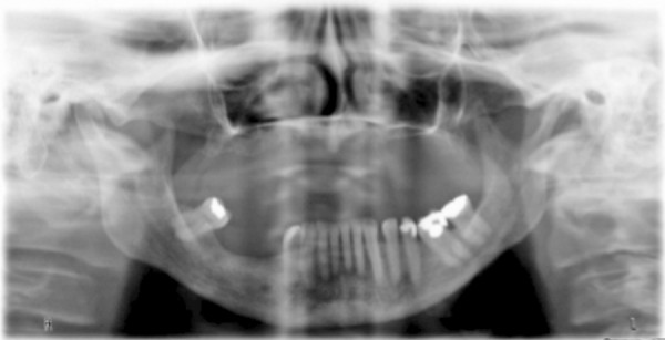 Zygomatic Implants For The Rehabilitation Of The Severely Atrophic ...