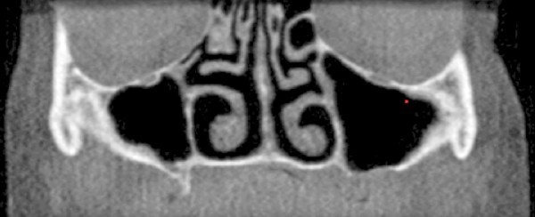 Zygomatic Implants For The Rehabilitation Of The Severely Atrophic ...