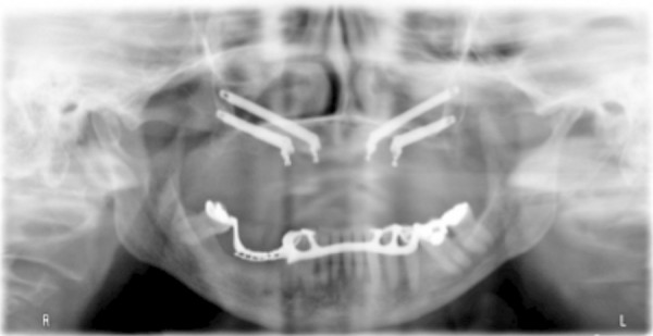 Zygomatic Implants For The Rehabilitation Of The Severely Atrophic ...