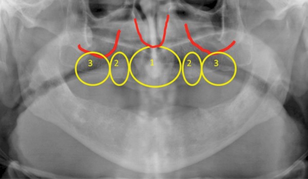 Zygomatic Implants For The Rehabilitation Of The Severely Atrophic ...