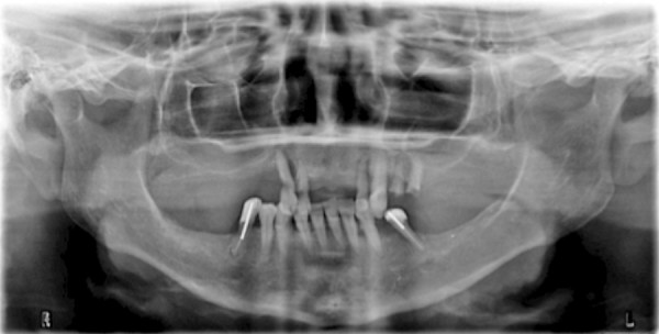 Zygomatic Implants For The Rehabilitation Of The Severely Atrophic ...