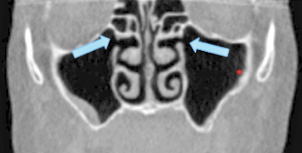 Zygomatic Implants For The Rehabilitation Of The Severely Atrophic ...