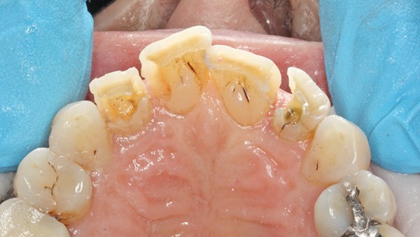 Porcelain Therapy: Veneers vs Jacket Crowns, the ALARA Principle for ...