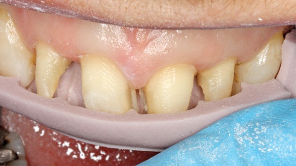 Porcelain Therapy: Veneers vs Jacket Crowns, the ALARA Principle for ...