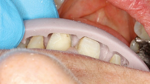 Porcelain Therapy: Veneers vs Jacket Crowns, the ALARA Principle for ...