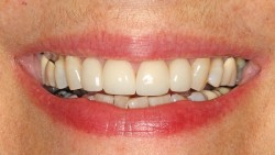 Porcelain Therapy: Veneers vs Jacket Crowns, the ALARA Principle for ...