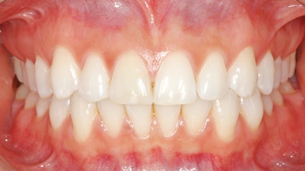 Porcelain Therapy: Veneers vs Jacket Crowns, the ALARA Principle for ...