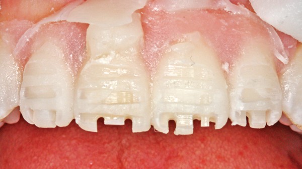 Porcelain Therapy: Veneers vs Jacket Crowns, the ALARA Principle for ...