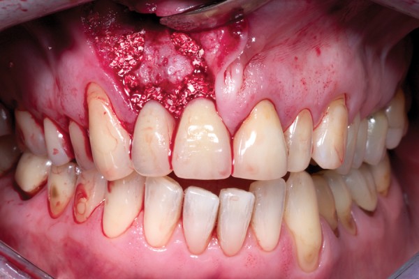 Bone Grafts For Implant Dentistry: The Basics - Oral Health Group