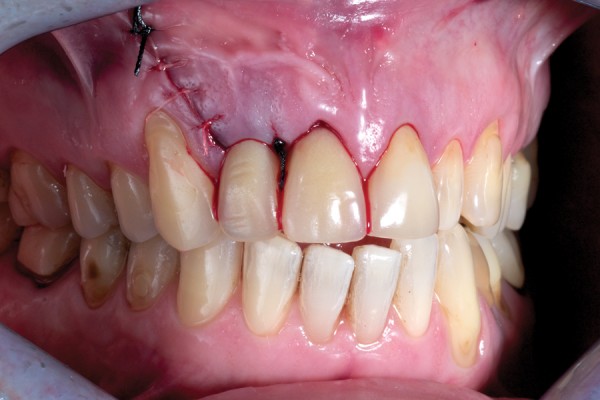 Bone Grafts For Implant Dentistry: The Basics - Oral Health Group