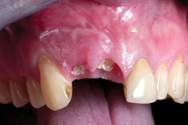 Bone Grafts For Implant Dentistry: The Basics - Oral Health Group