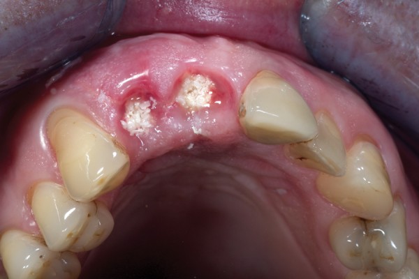 Bone Grafts For Implant Dentistry: The Basics - Oral Health Group
