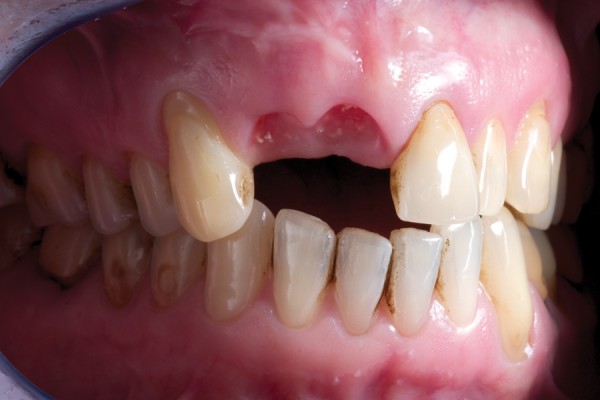 Bone Grafts For Implant Dentistry: The Basics - Oral Health Group