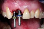 Bone Grafts For Implant Dentistry: The Basics - Oral Health Group
