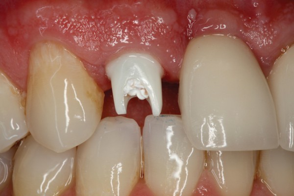 In Search of the Ideal Dental Cement…. Have We Arrived? - Oral Health Group