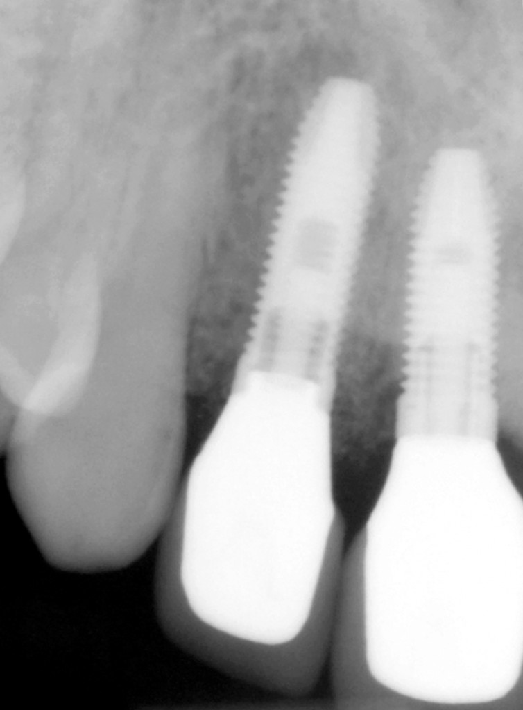 In Search of the Ideal Dental Cement…. Have We Arrived? - Oral Health Group