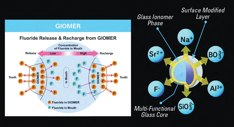 Giomer Varnish for Prolonged Hypersensitivity Relief - Oral Health Group