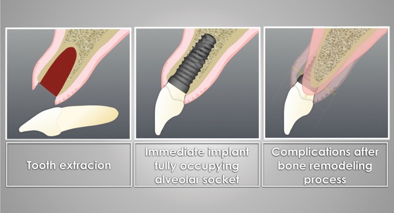 Update On Timing Of Implant Placement After Tooth Extraction - Oral ...