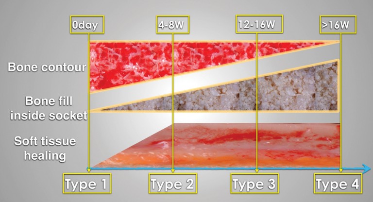 Update On Timing Of Implant Placement After Tooth Extraction - Oral ...