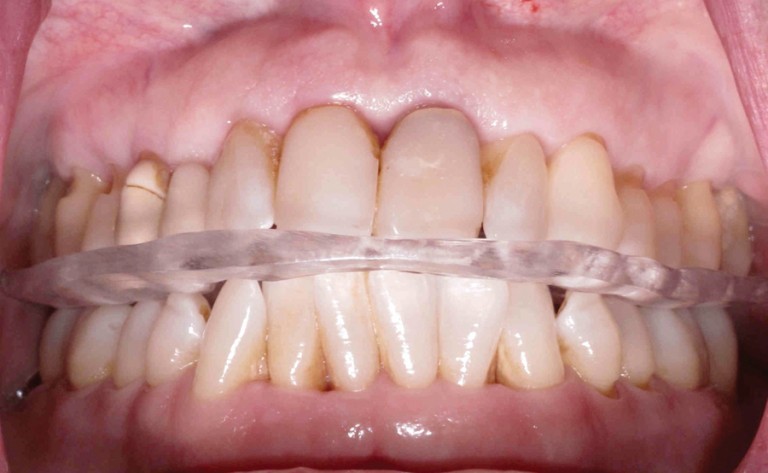 Predictable Immediate Implant Prosthetics using Guided Surgery and ...