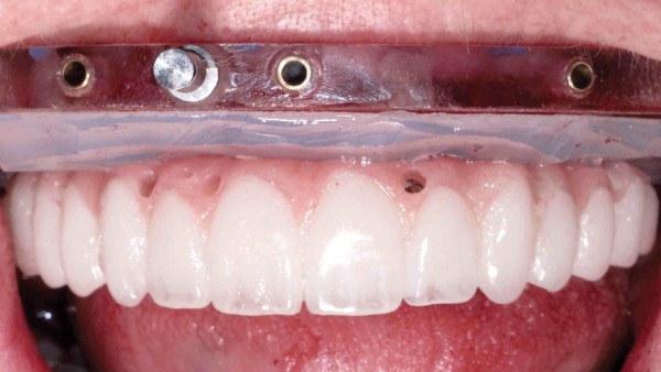 Predictable Immediate Implant Prosthetics using Guided Surgery and ...