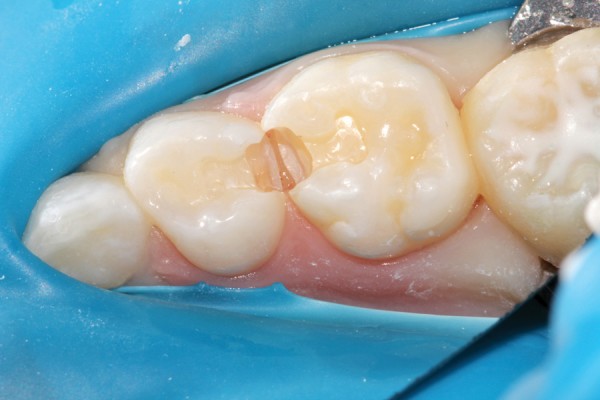 Composites for Children Made X-tra Easy - Oral Health Group