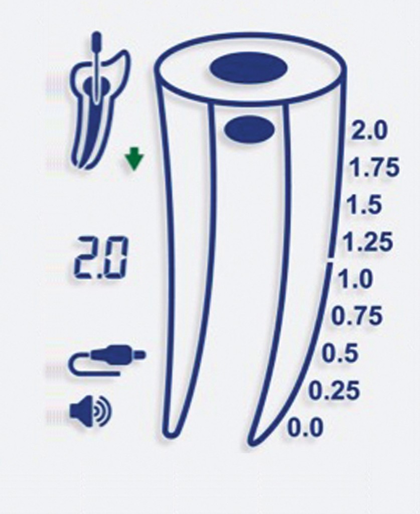 Know Your Apical Limit – The Value of Modern Apex Locators in the ...