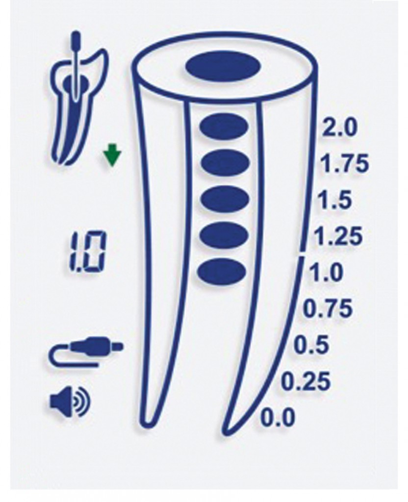 Know Your Apical Limit – The Value of Modern Apex Locators in the ...