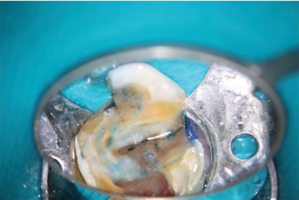 The Cracked Tooth: Diagnosis and Management - Oral Health Group