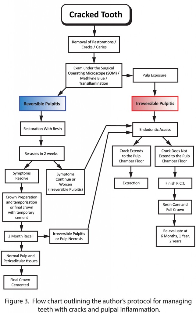 The Cracked Tooth: Diagnosis and Management - Oral Health Group