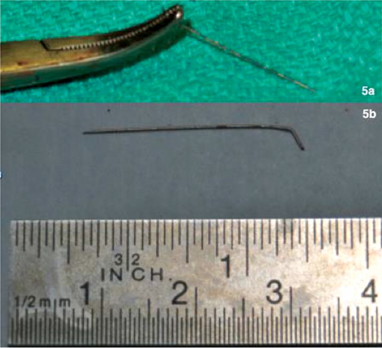 Needle Fracture During Inferior Alveolar Nerve Block: A Case Report of ...
