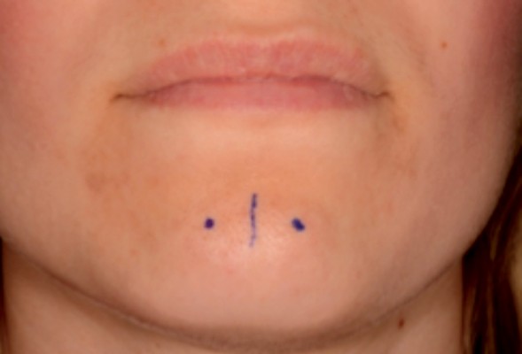 Botox® for Reduction of Post-Bone Graft Resorption with Anterior ...