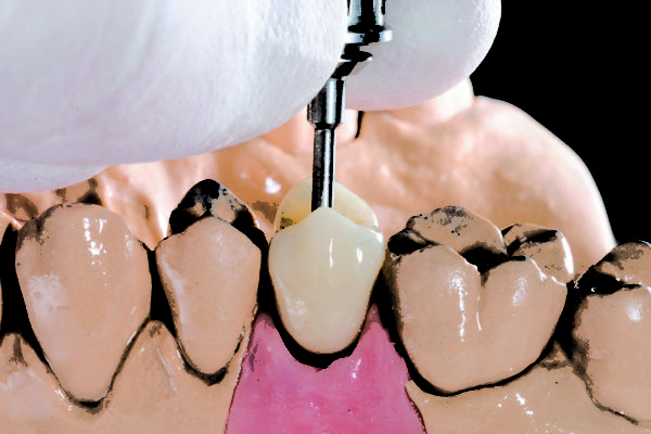 The Screwmentable - Oral Health Group