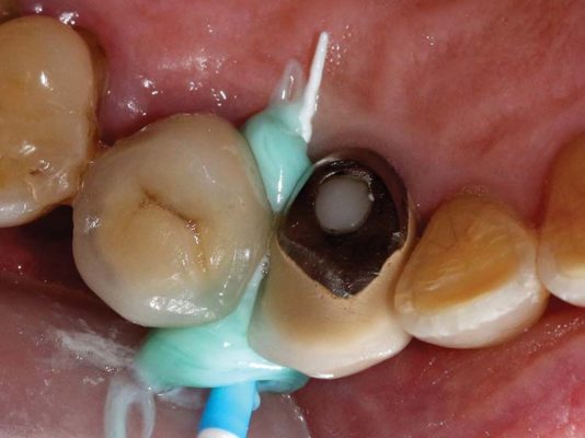 Gum Disease Starts Between the Teeth - Oral Health Group