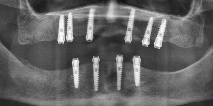 Arlin Case 2 image 20 3 years rev - Oral Health Group