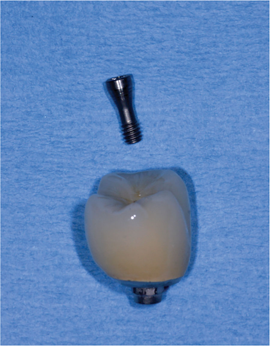Dynamic Surgical Guidance to Facilitate Dental Implant Placement: A ...