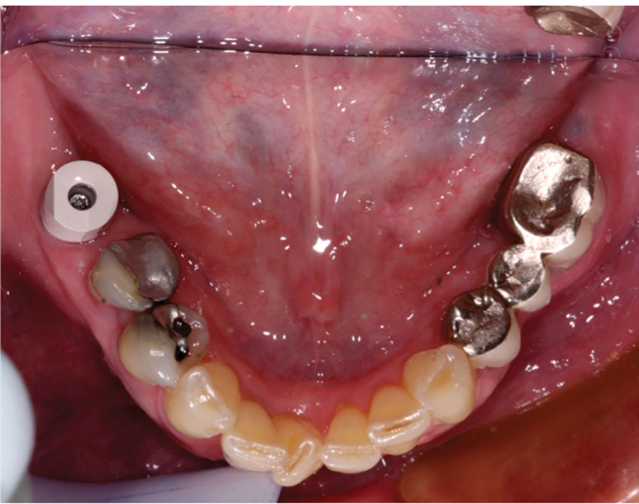 Dynamic Surgical Guidance to Facilitate Dental Implant Placement: A ...
