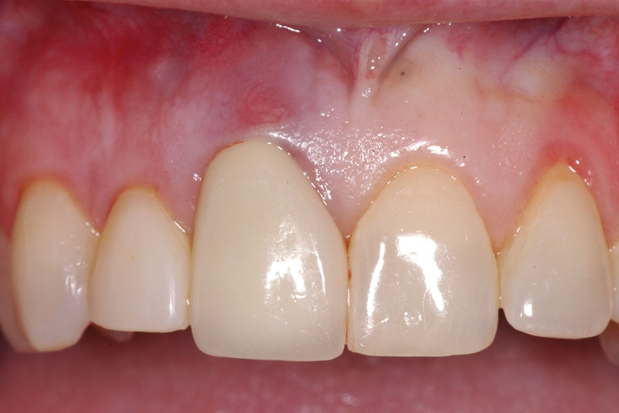An Updated Approach to Ridge Preservation - Oral Health Group