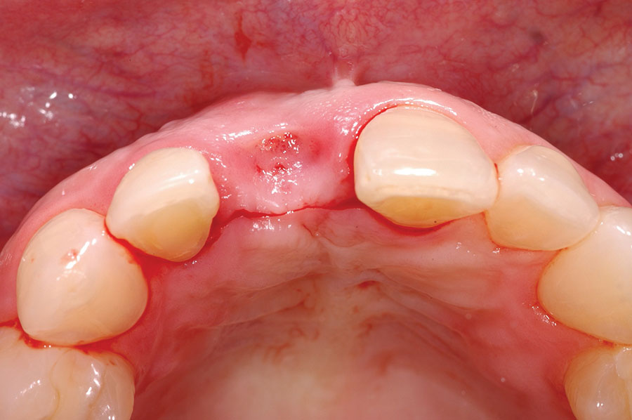 An Updated Approach to Ridge Preservation - Oral Health Group
