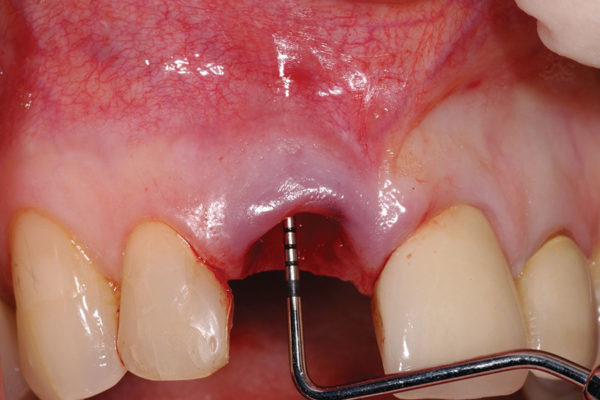 An Updated Approach to Ridge Preservation - Oral Health Group
