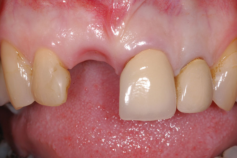 An Updated Approach to Ridge Preservation - Oral Health Group