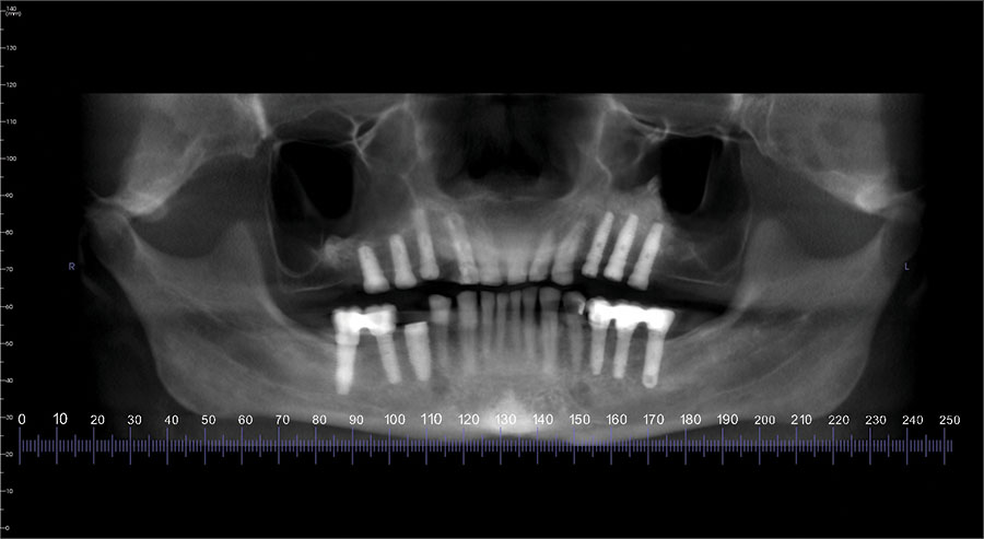 CAD-CAM Surgical Guides for Implantology: The New, The Old and The ...