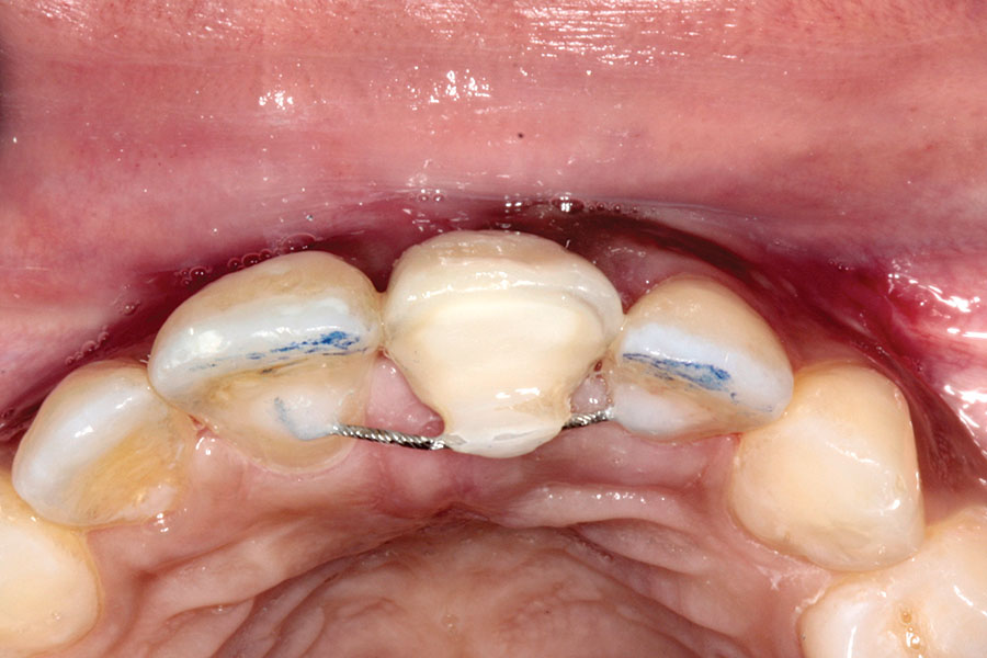 A Stepwise Approach: Restoring a Failed Maxillary Anterior Tooth