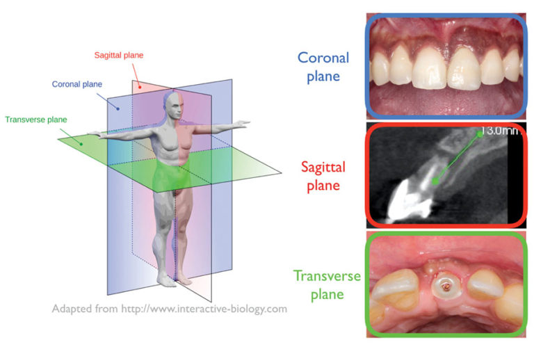 A Stepwise Approach: Restoring a Failed Maxillary Anterior Tooth