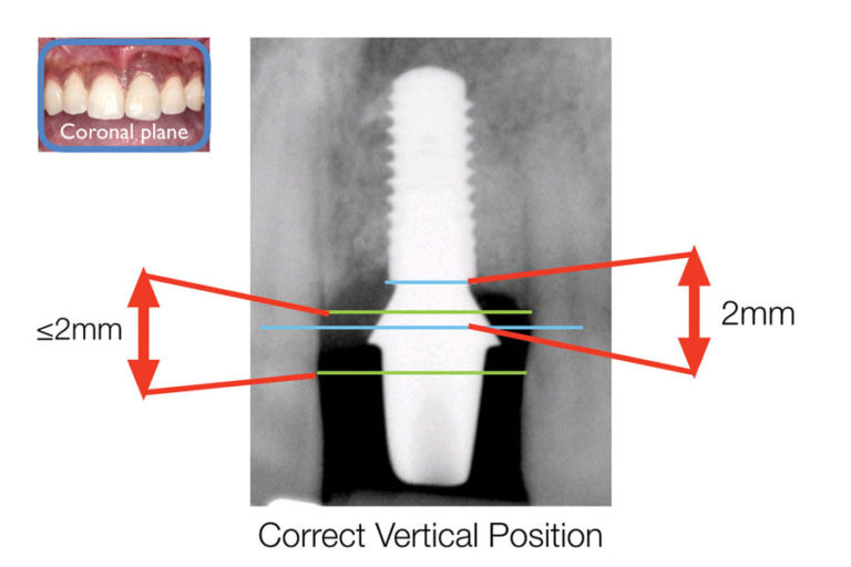 A Stepwise Approach: Restoring a Failed Maxillary Anterior Tooth
